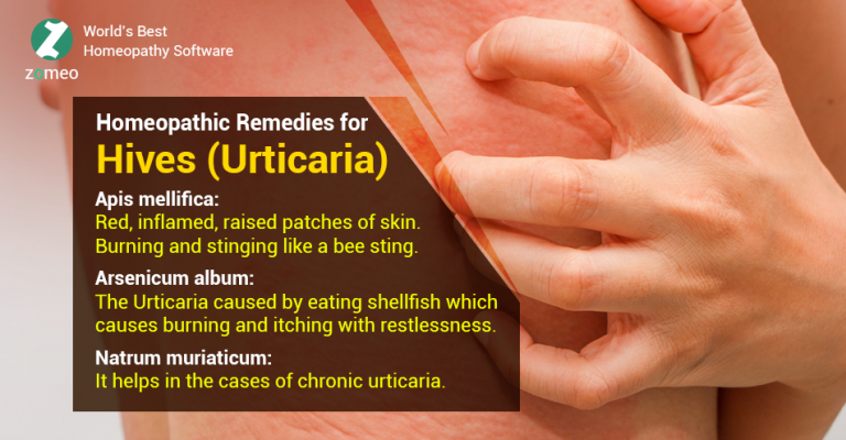 Homeopathic Remedies for Hives (Urticaria) – Hompath
